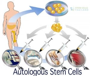 Iliac Crest Bone Marrow Aspiration and Grafting Site