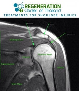 Stem Cells Treatment for Shoulder Injury Arthritis & Labral Tear