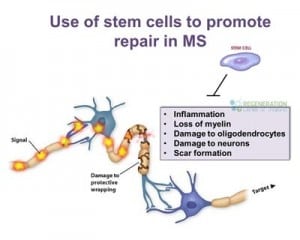 Stem Cell Treatment for Multiple Sclerosis - MS PLS HSCT