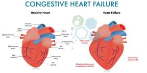 Cardiopoietic Stem Cell Therapy Congestive Heart Failure [CHF]