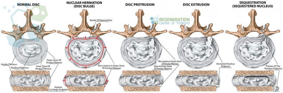 Can Stem Cells Help Reverse Degenerative Disc Disease?
