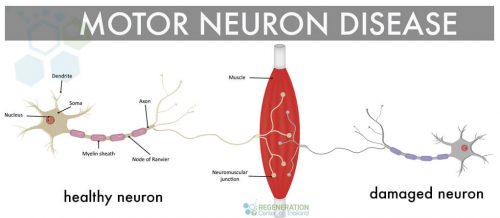 Stem Cell Treatment for Motor Neuron Disease MND