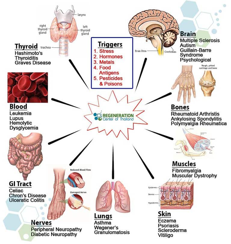 UC-MSC+ Stem Cell Treatment for Autoimmune Diseases in 2025