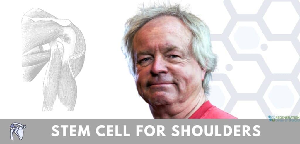 Stem Cells Treatment for Shoulder Injury Arthritis & Labral Tear