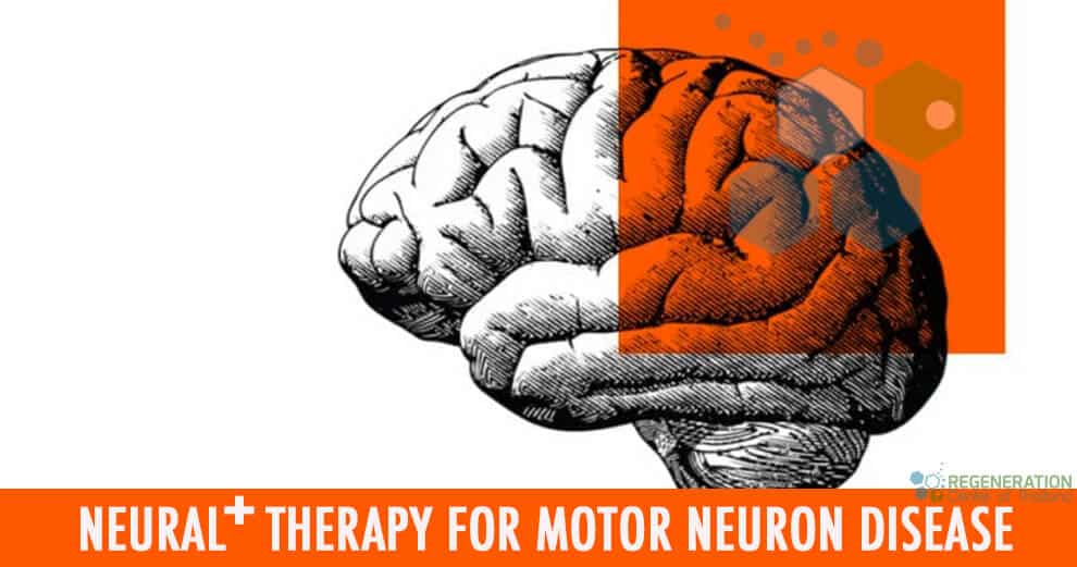 Stem Cell Treatment For Motor Neuron Disease Mnd