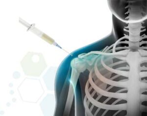 Stem Cell Therapy For Rotator Cuff Instead Of Surgery?