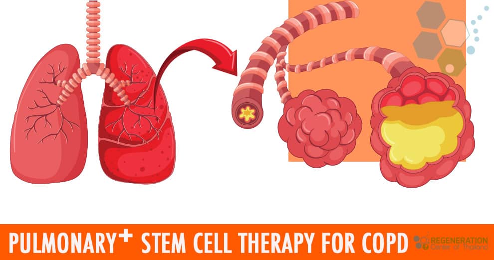 Pulmonary+ Stem Cell Treatment for COPD & Emphysema