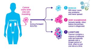 CAR-T Cell Immunotherapy & Stem Cells for Kidney Cancer RCC