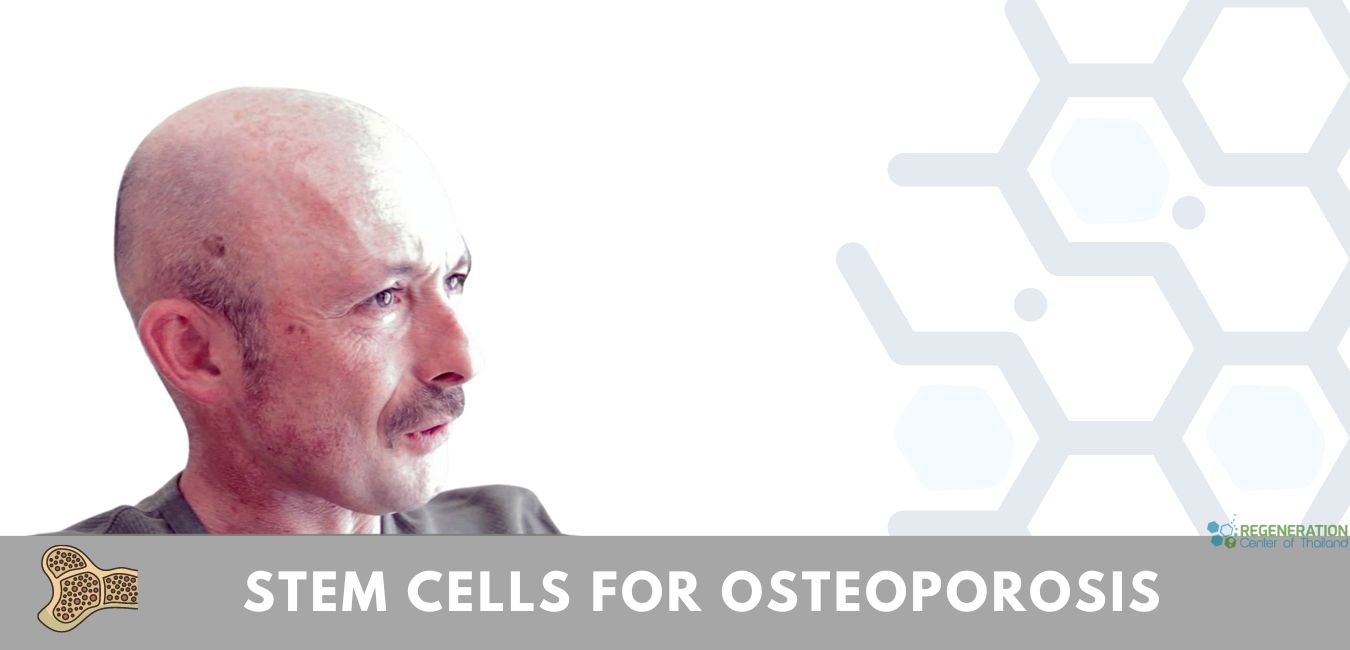 Stem Cell Treatment for Osteoporosis & Bone Regeneration
