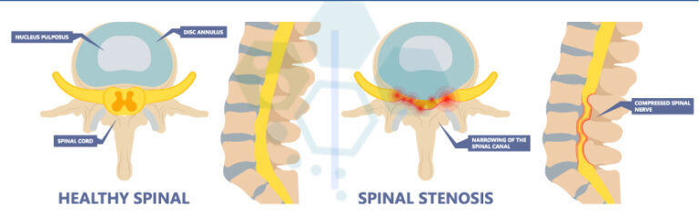 Evidence Based Stem Cell Treatment for Spinal Stenosis