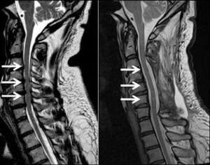 Evidence Based Stem Cell Treatment for Spinal Stenosis