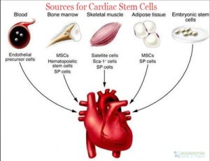 Stem Cell Therapy for Heart Disease Atherosclerosis CAD IHD