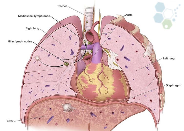 T-Cell Immunotherapy & Stem Cell Treatment for Lung Cancer