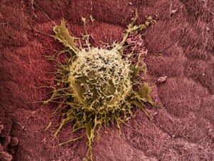 Isolated Bone marrow mesenchymal stem cell transplants - BMSC