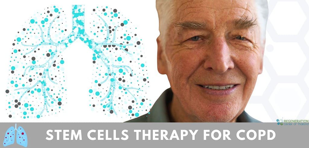 Exogenous Stem Cell Therapy for COPD & Emphysema Lung