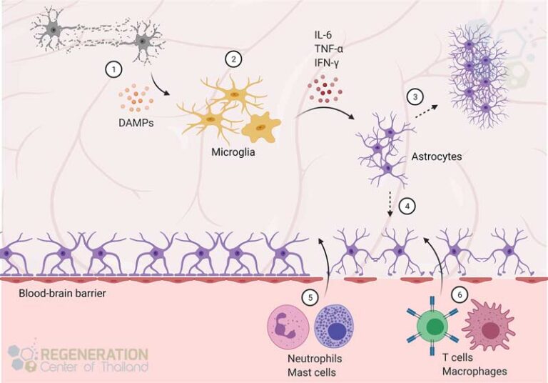 Stem Cell Treatment for Motor Neuron Disease MND