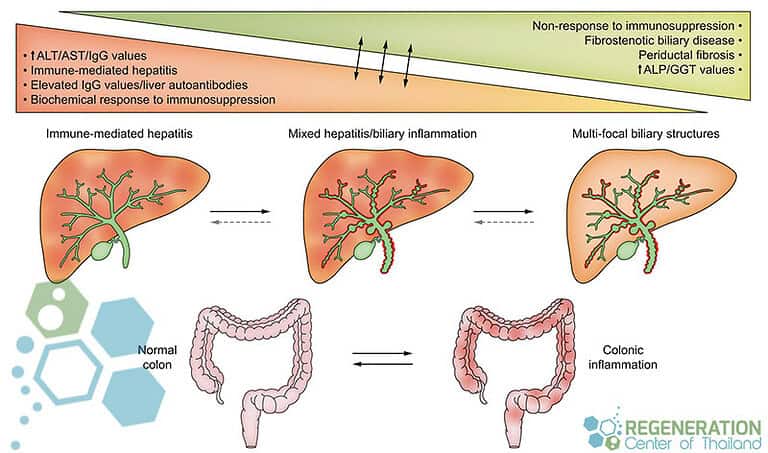 Stem Cell Treatment for Primary Sclerosing Cholangitis ( PSC )